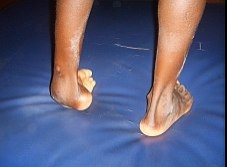 Séquelles d’injection intrafessière de Quinimax, avec la déformation ...